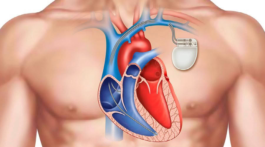 Getting a Pacemaker? Watch an Implant Procedure! - Heartbeats Charitable Trust