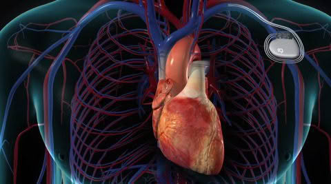 Pacemaker Insertion - Heartbeats Charitable Trust