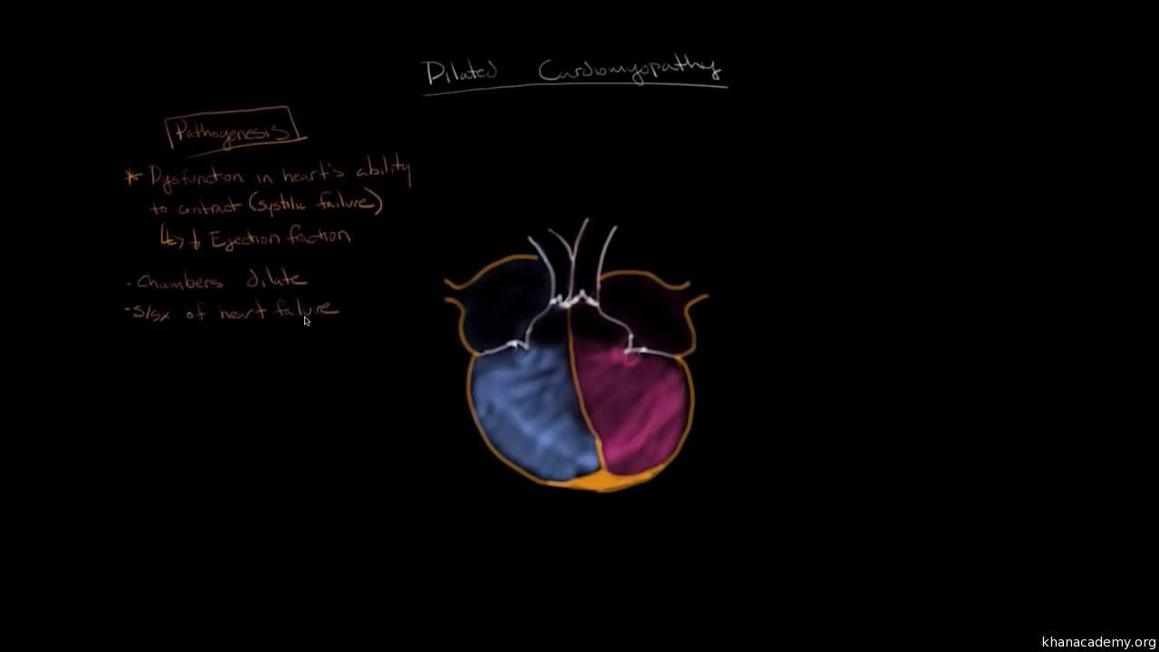 Dilated cardiomyopathy: Pathophysiology and diagnosis - Heartbeats ...